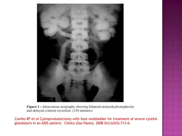 Cystitis Cystica and Glandularis | PPTX