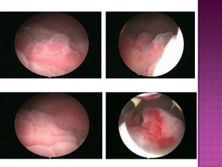 Cystitis Cystica and Glandularis | PPTX