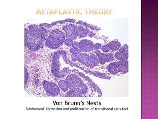 Cystitis Cystica and Glandularis | PPT