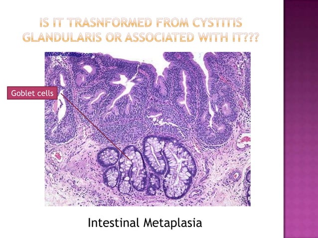 Cystitis Cystica and Glandularis | PPTX