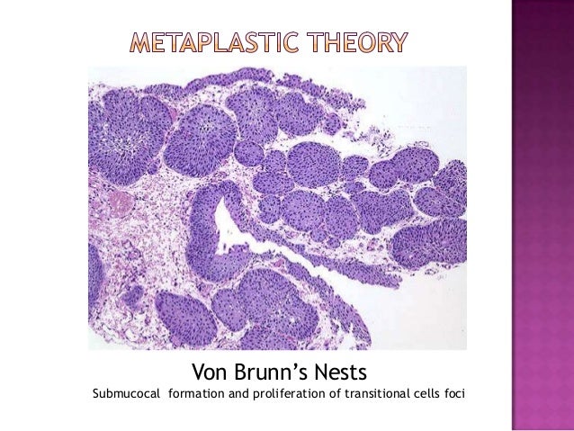 Cystitis Cystica and Glandularis