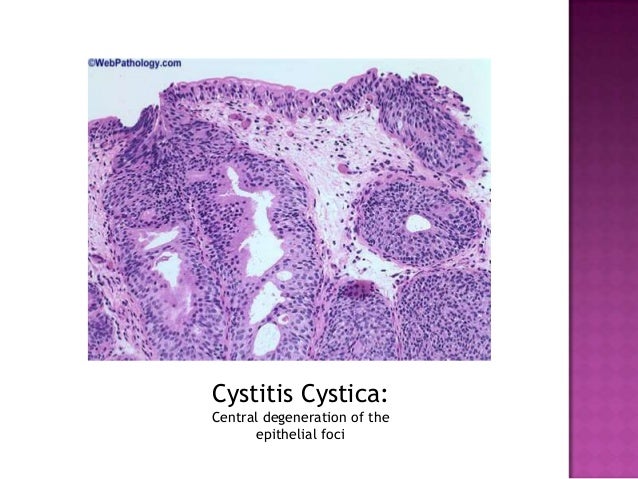 Cystitis Cystica and Glandularis