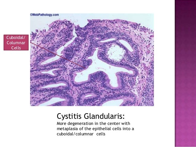 Cystitis Cystica and Glandularis