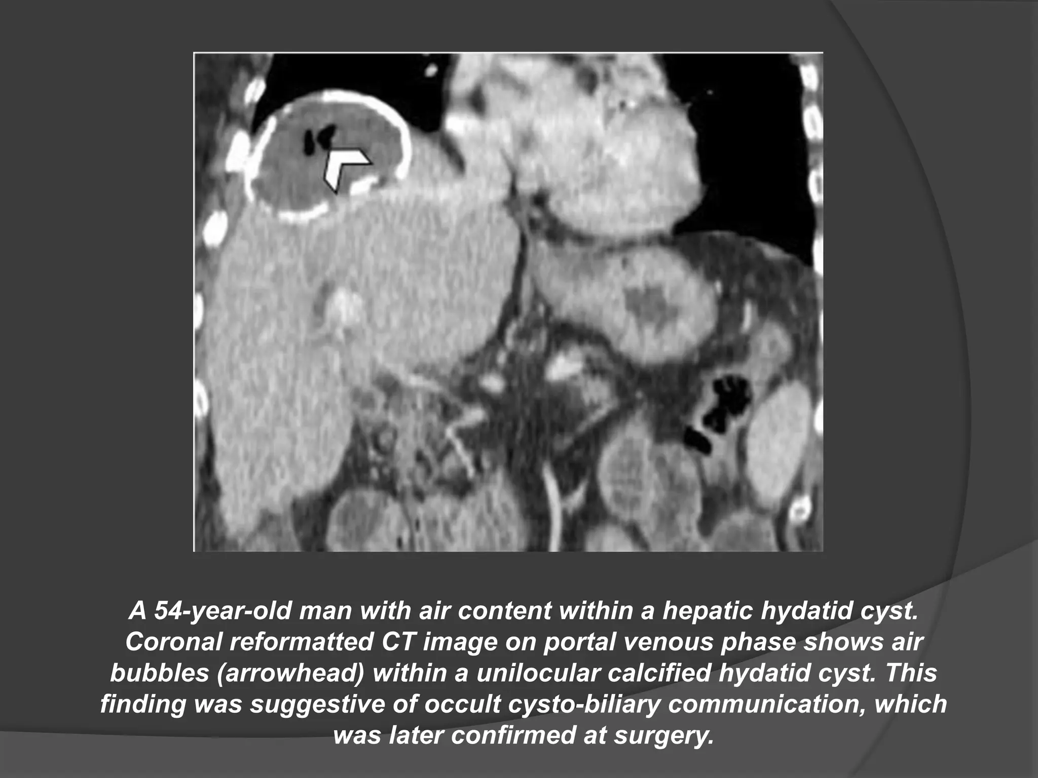 cystobiliary fistula a common complication of hepatic hydatid cyst .pptx