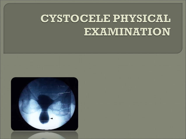 Cystocele physical examination | PPT