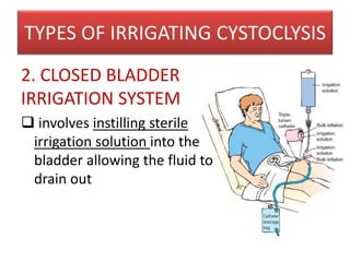 Cystoclysis bladder irrigation | PPTX