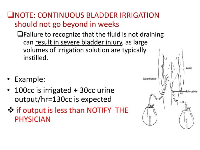 Cystoclysis bladder irrigation | PPTX