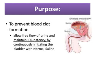 Cystoclysis bladder irrigation | PPTX