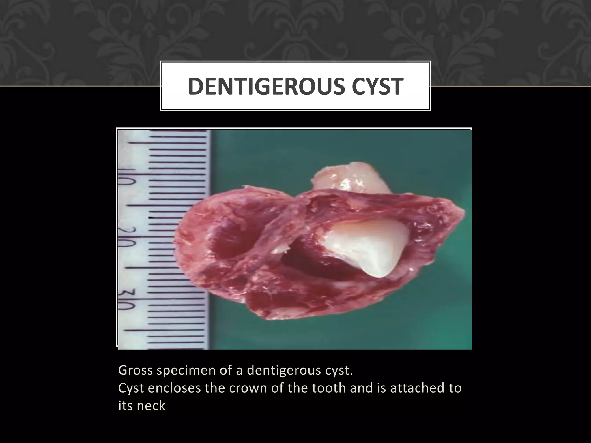 Cyst Of Jaw | PPTX