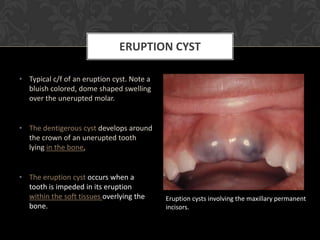 Eruption Cyst Radiography