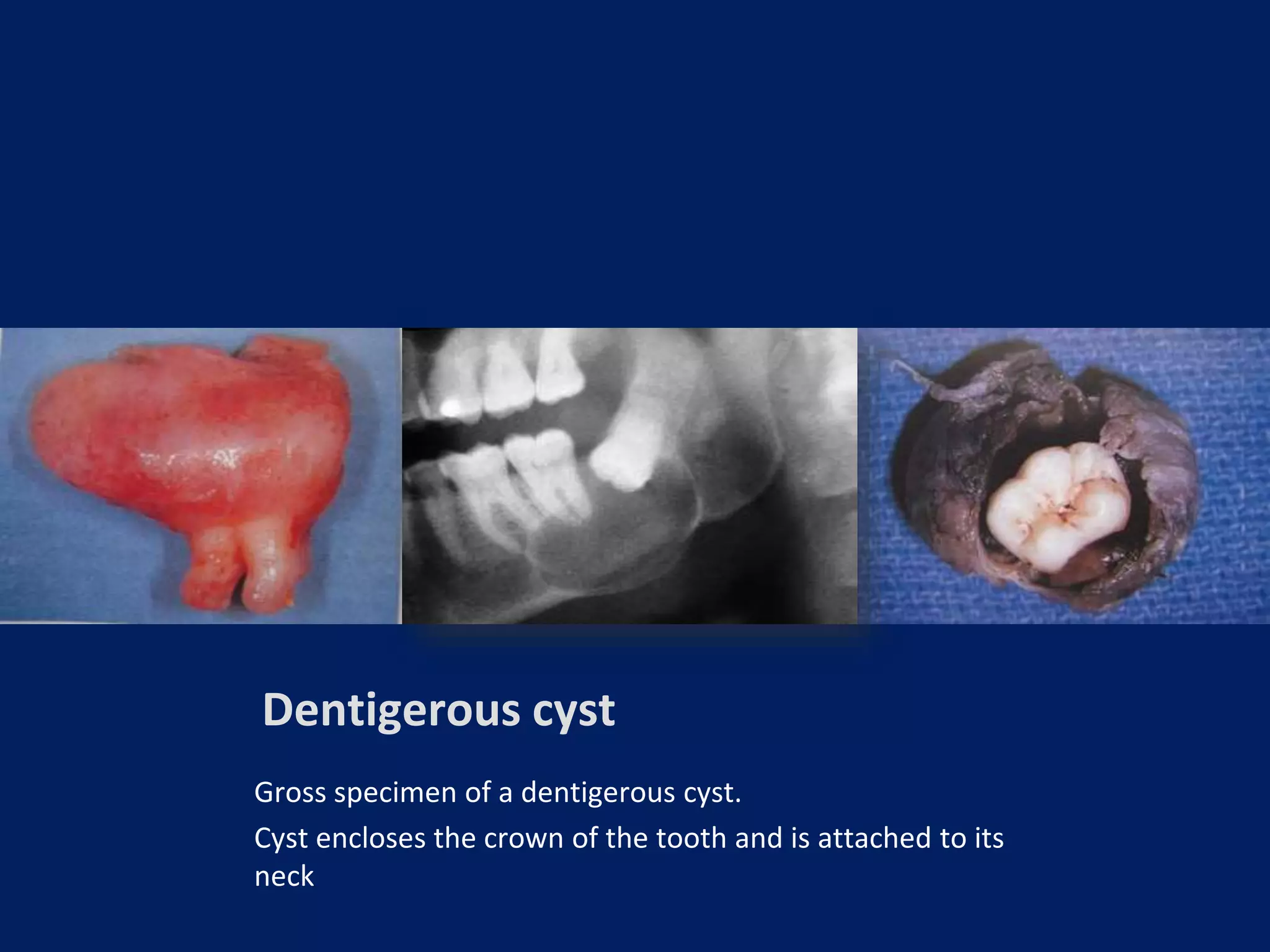 cysts of the oral and maxillofacial region | PPTX