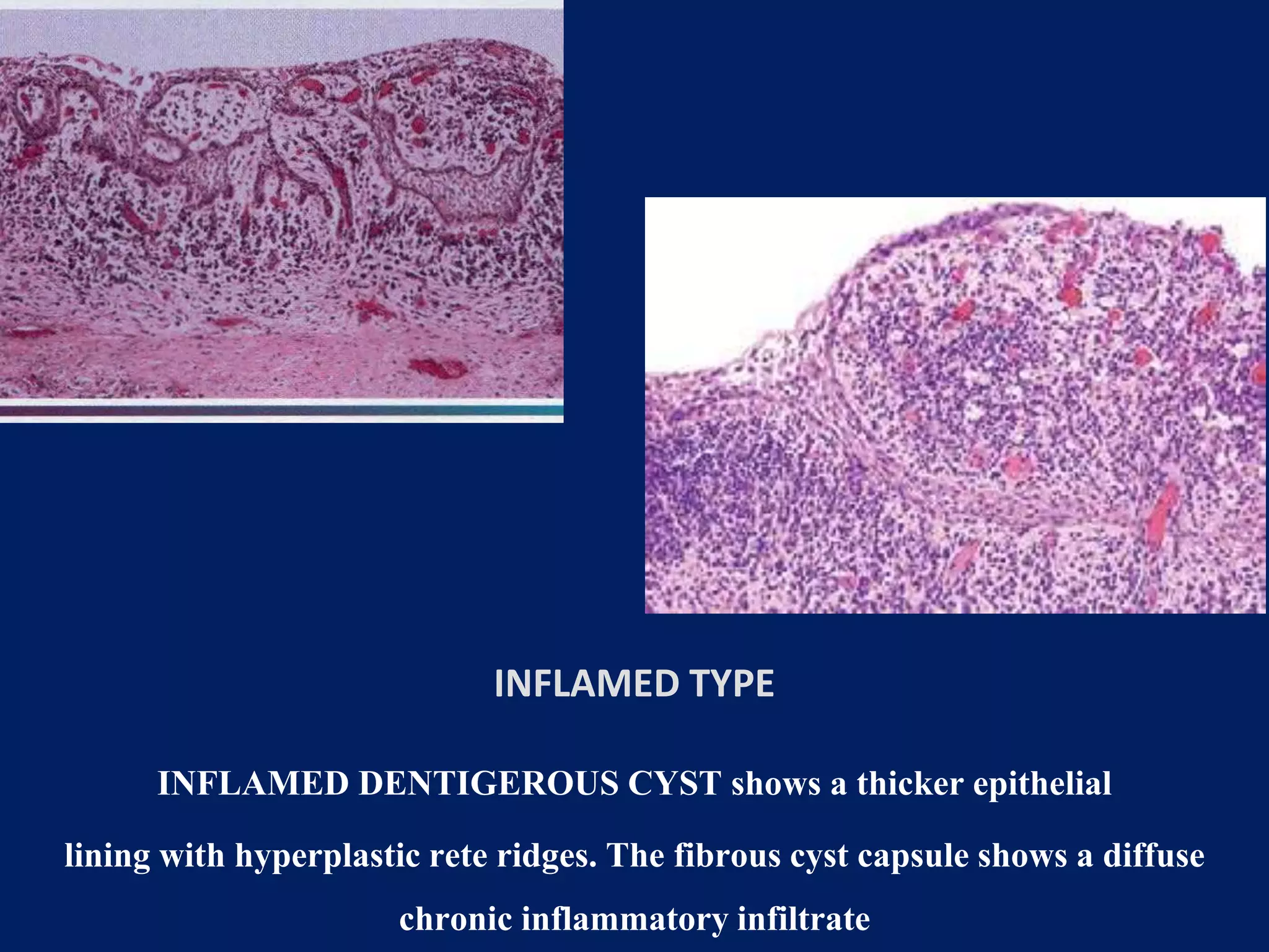 cysts of the oral and maxillofacial region | PPTX