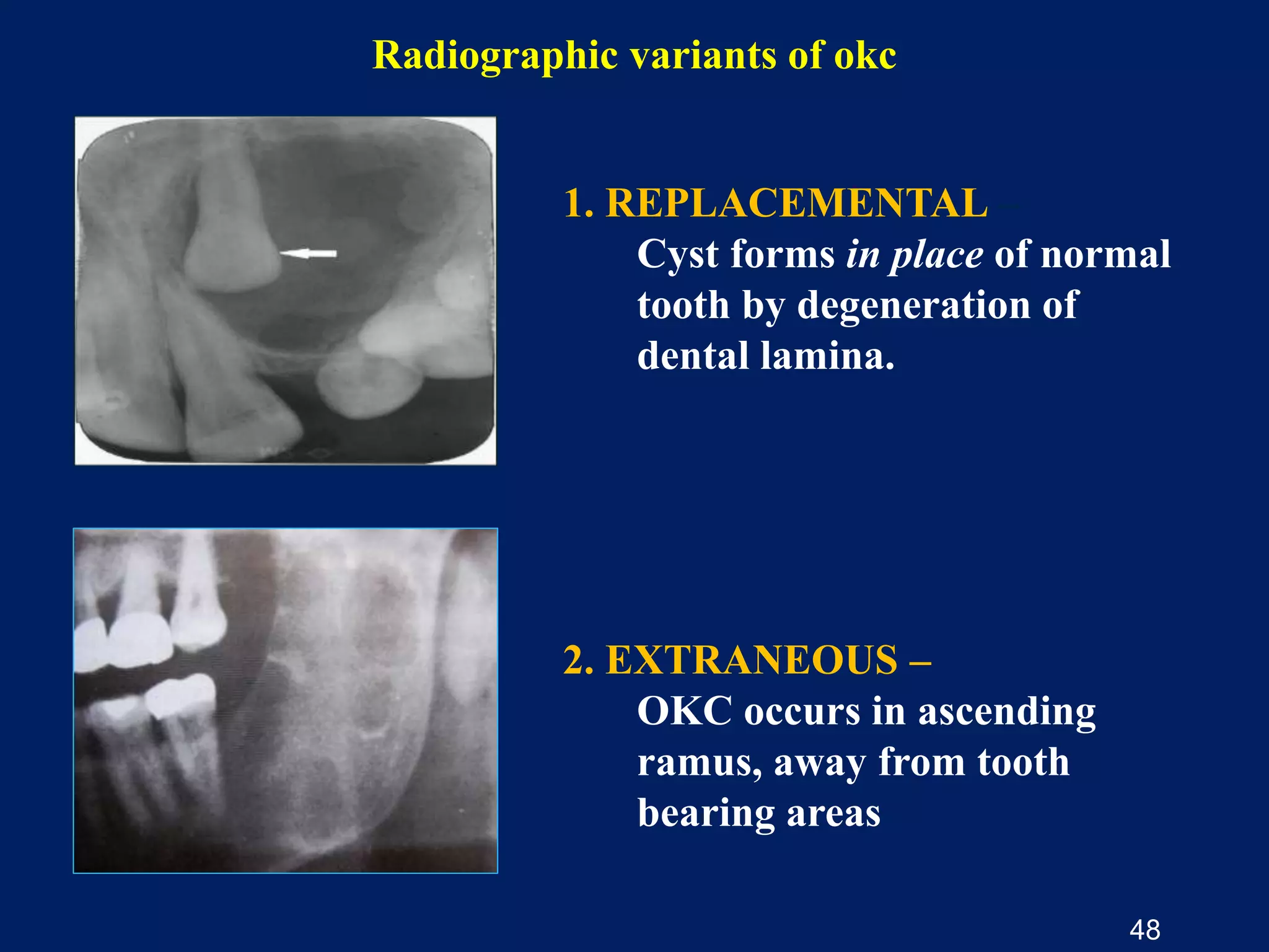 cysts of the oral and maxillofacial region | PPTX