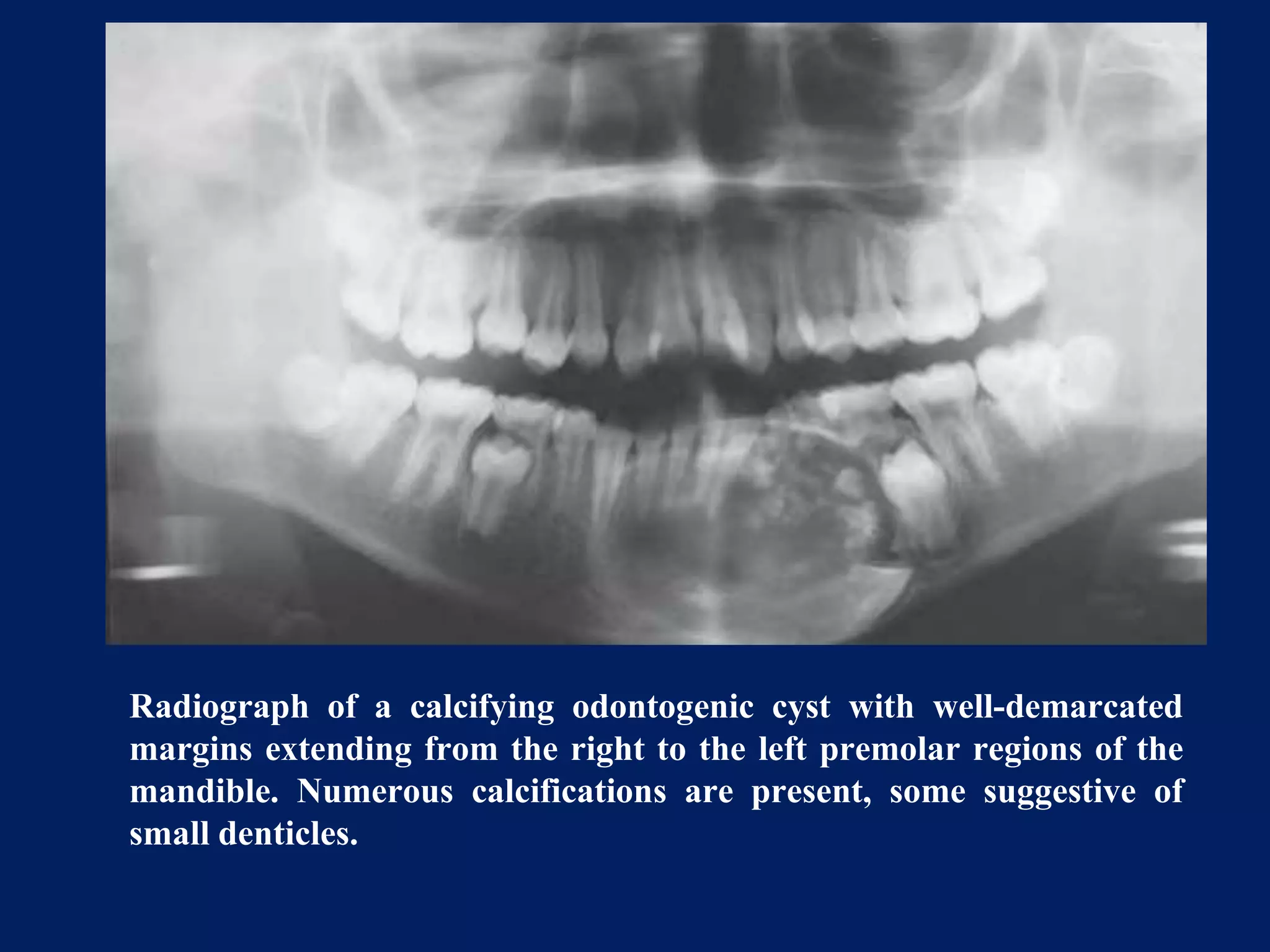 cysts of the oral and maxillofacial region | PPTX