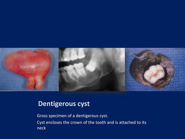 cysts of the oral and maxillofacial region | PPTX