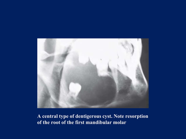 cysts of the oral and maxillofacial region | PPTX