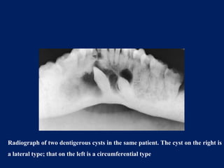 cysts of the oral and maxillofacial region | PPTX