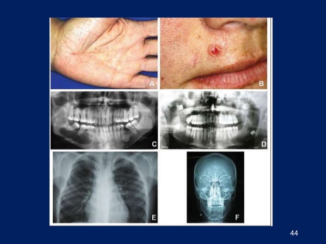 cysts of the oral and maxillofacial region | PPTX