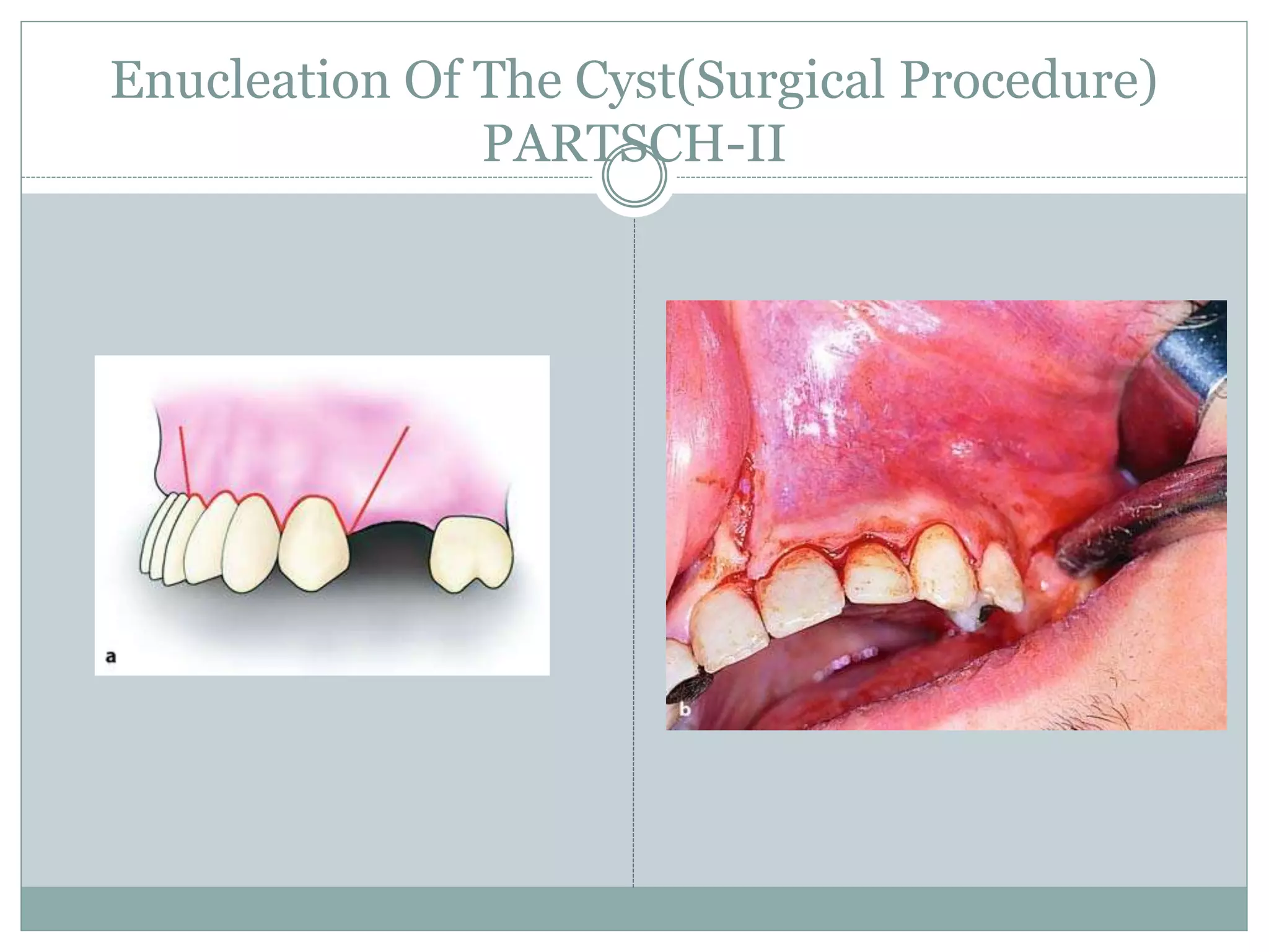 Cyst of jawsnet | PPTX