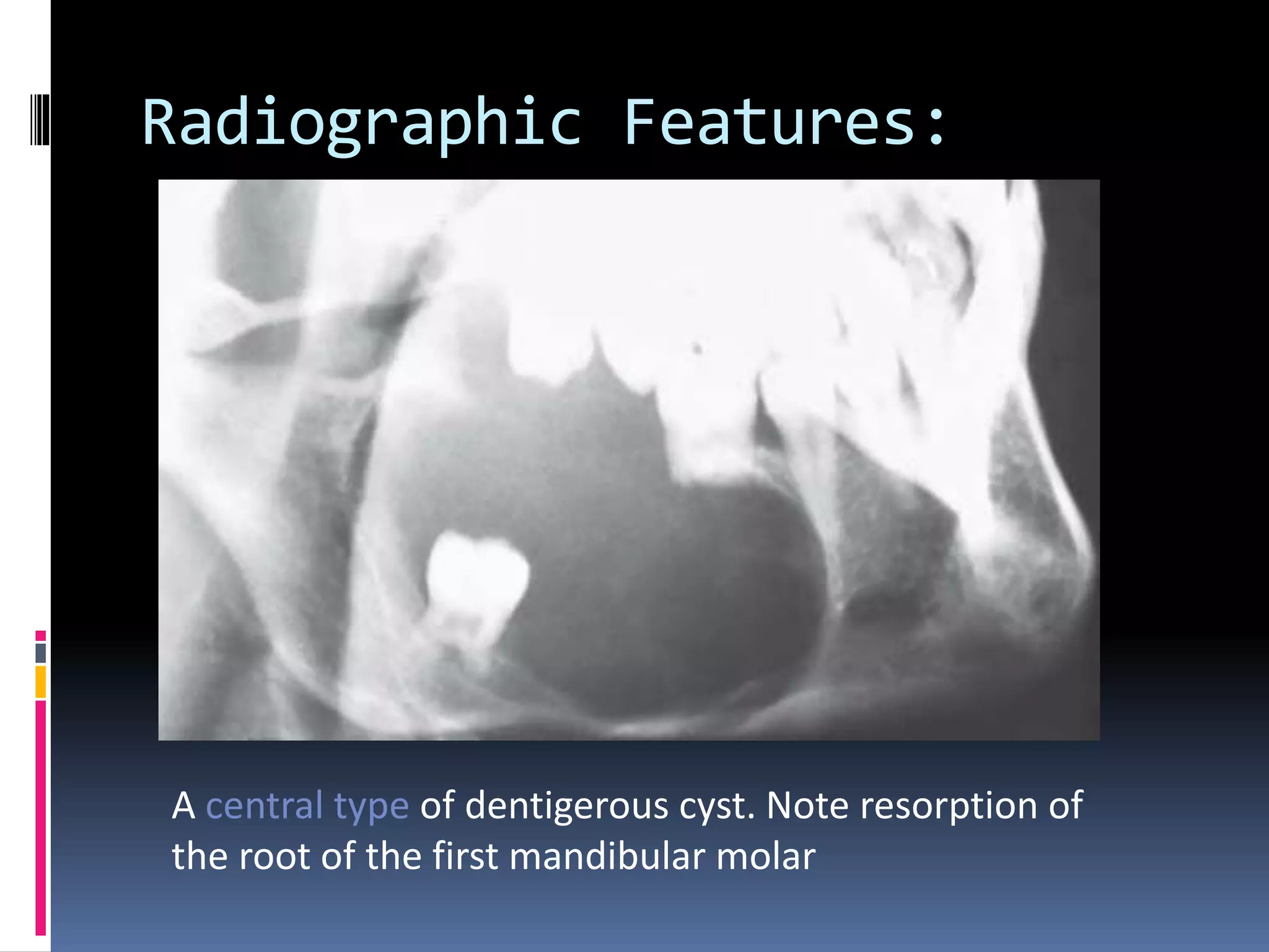 Cysts of the Oral Cavity | PPTX