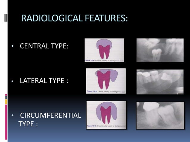 Cysts of the Oral Cavity | PPT