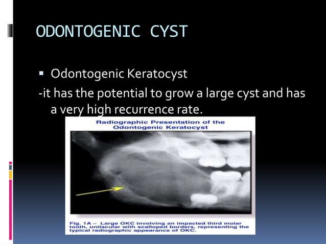 Cysts of the Oral Cavity | PPTX | Dental Health | Diseases and Conditions