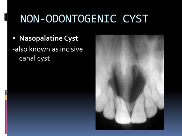 Cysts of the Oral Cavity | PPT