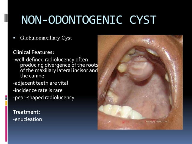 Cysts of the Oral Cavity