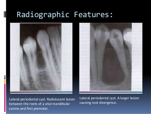 Cysts of the Oral Cavity