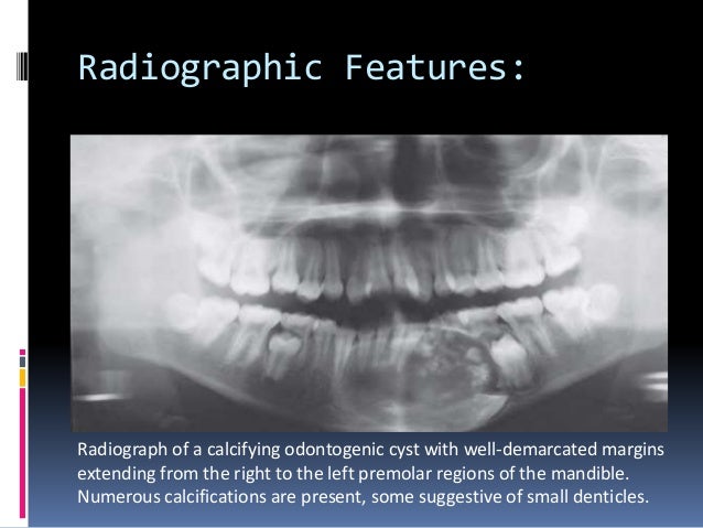 Calcifying Epithelial Odontogenic Cyst