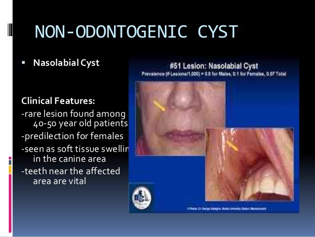 Cysts of the Oral Cavity