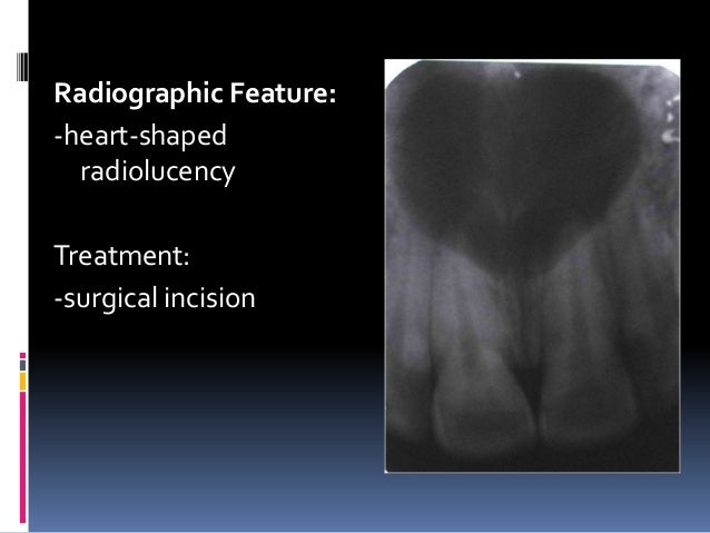 Cysts of the Oral Cavity