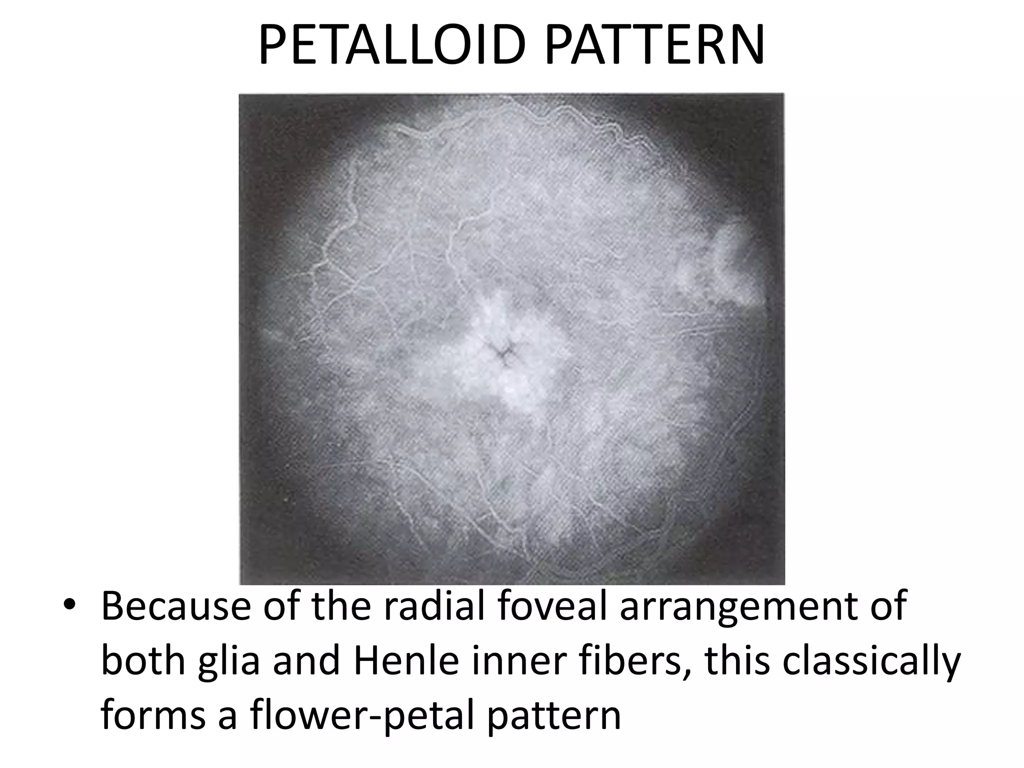 Cystoid macular edema | PPTX