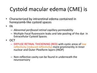 Cystoid macular edema | PPTX