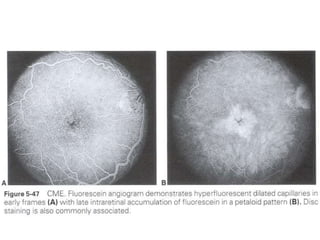 Cystoid Macular Edema Fluorescein Angiography