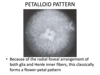 Cystoid macular edema | PPTX