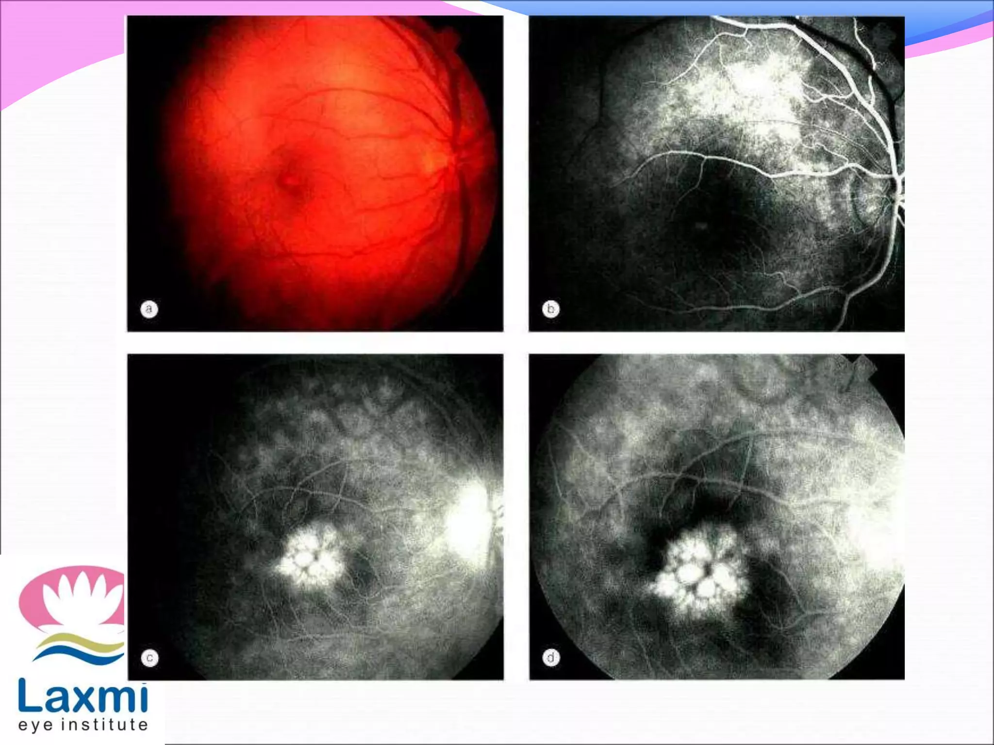 Cystoid macular oedema | PPTX