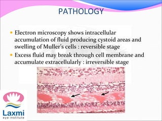 Cystoid Macular Edema Histology