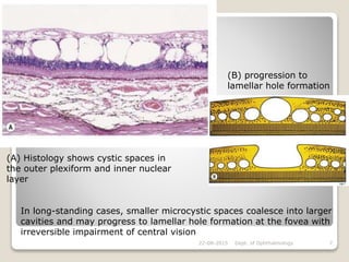 Cystoid Macular Edema Histology