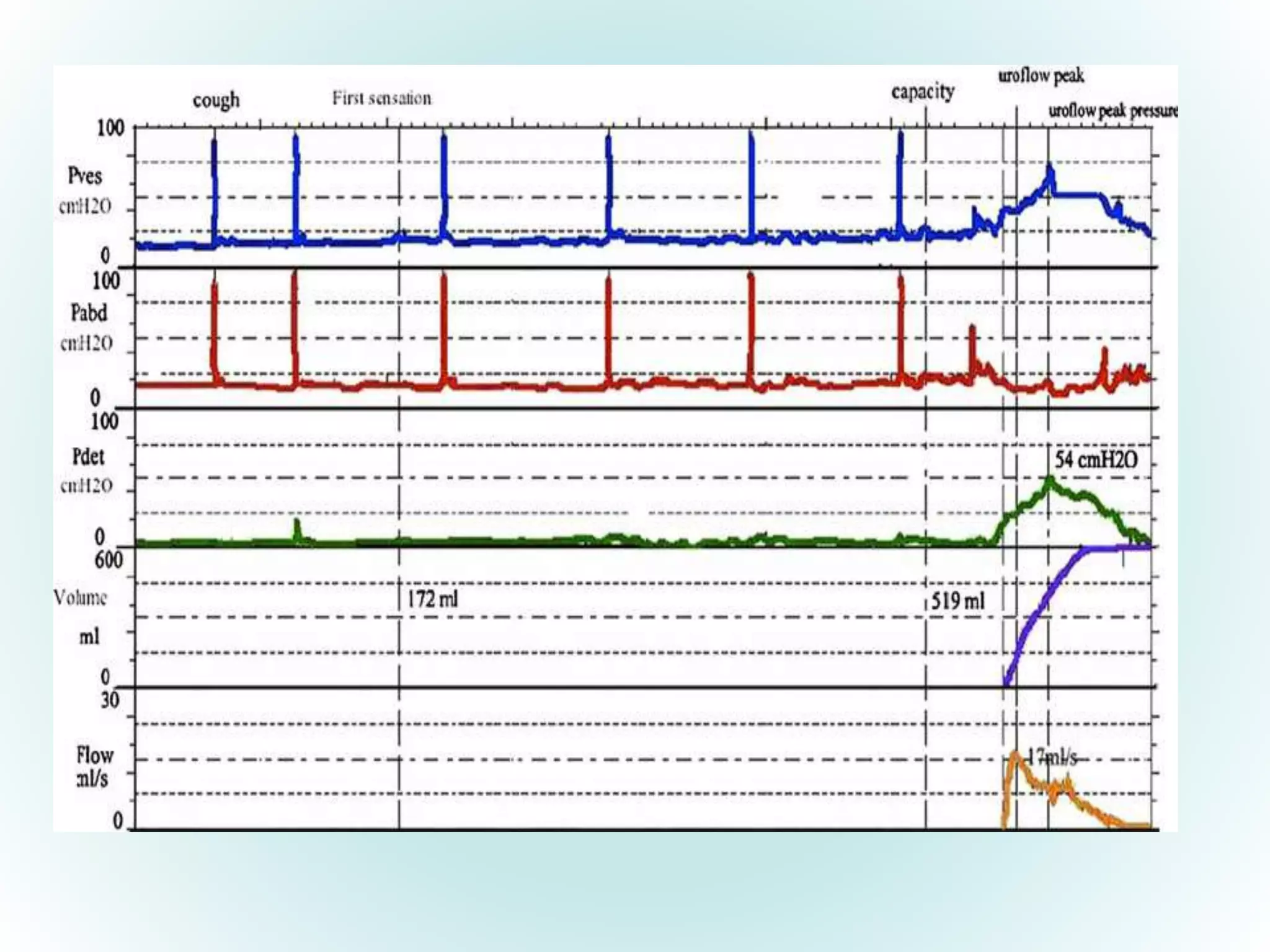Cystometrogram Storage Phase | PPTX