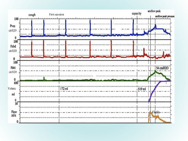 Cystometrogram Storage Phase | PPT