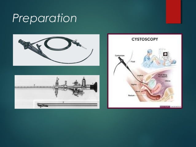 CYSTOSCOPY | PPT