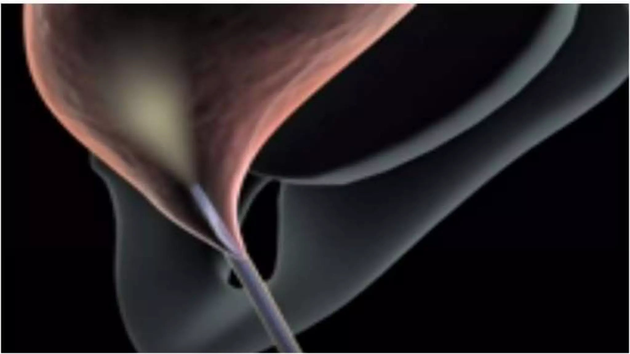 Cystoscopy | PPTX