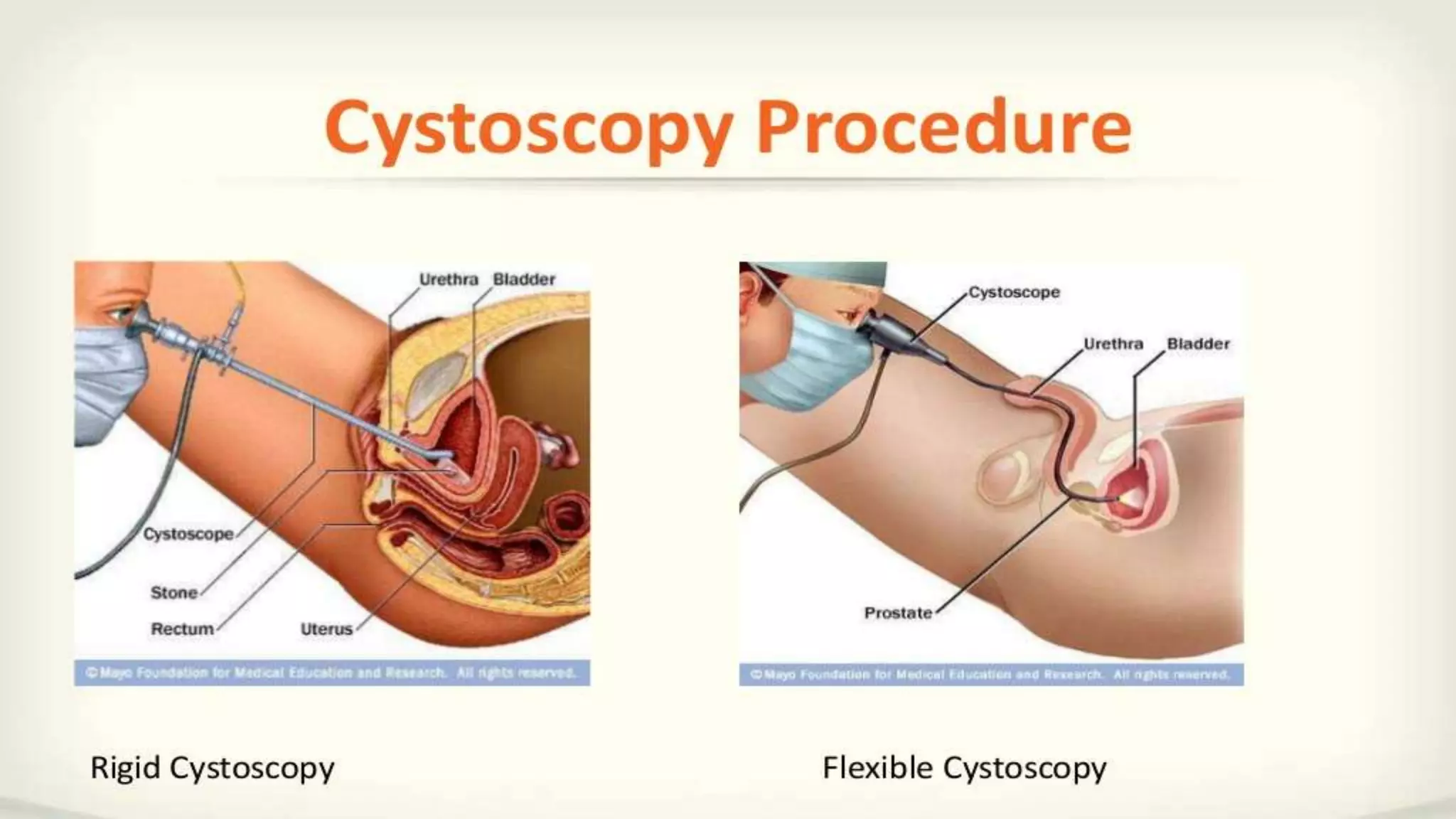Cystoscopy | PPTX