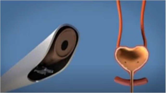 Cystoscopy | PPTX | Surgery | Medical Health