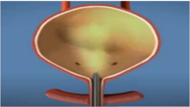 Cystoscopy | PPTX | Surgery | Medical Health