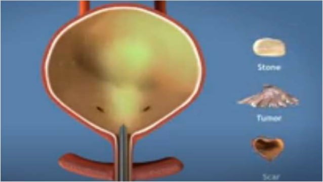 Cystoscopy | PPTX | Surgery | Medical Health