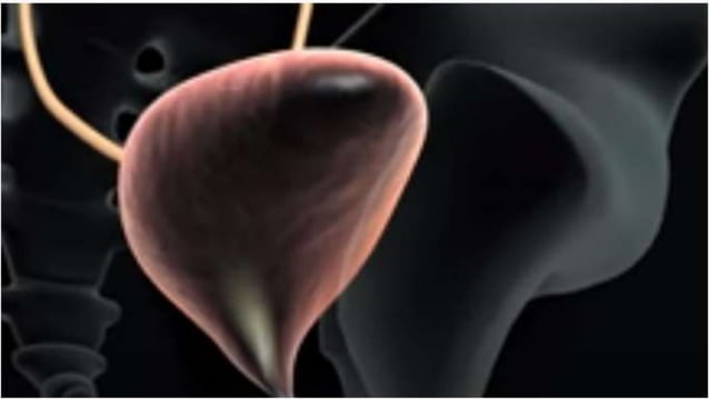 Cystoscopy | PPTX | Surgery | Medical Health