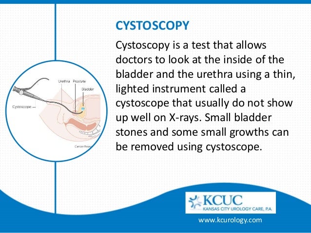 Cystoscopy - Detect and Treat Symptoms of Bladder Cancer