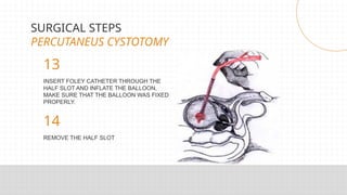 OPTEK ILMIAH CYSTOTOMY BEDAH UROLOGI.pptx